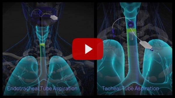 Subglottic Aspiration System Practical Hospital Services
